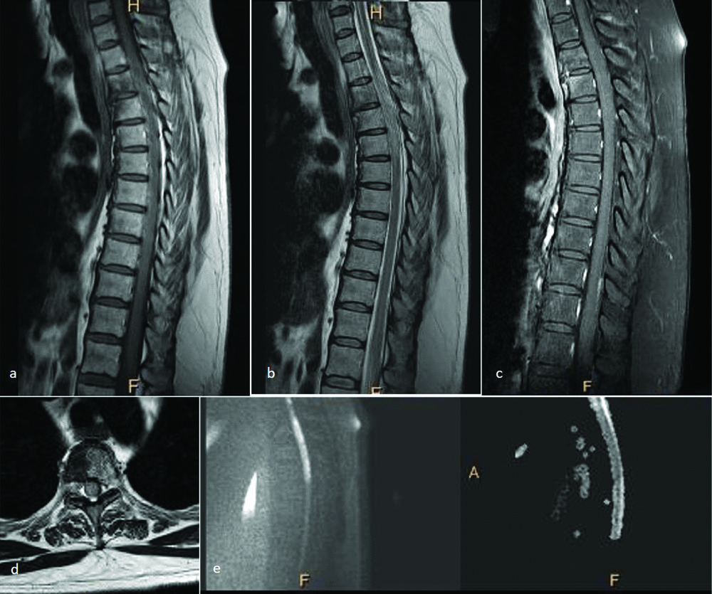 Spinal Cord Haemorrhage