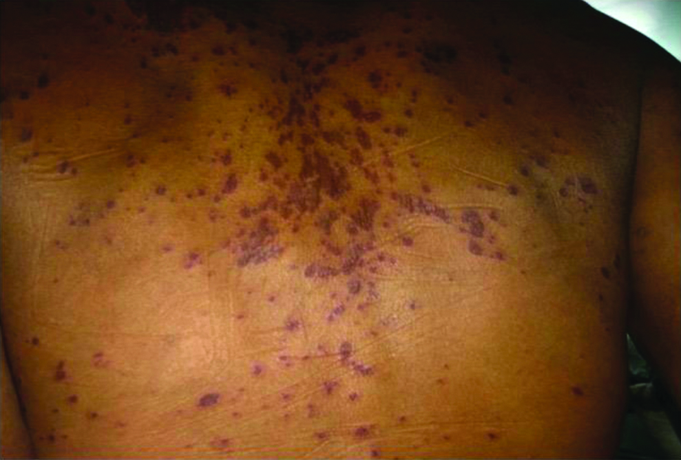 Non blanchable maculopapular lesions.