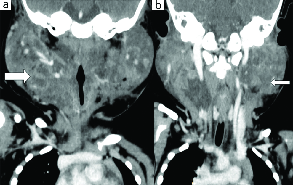 Contrast enhanced CT scan of neck (coronal) showing multilocular ...