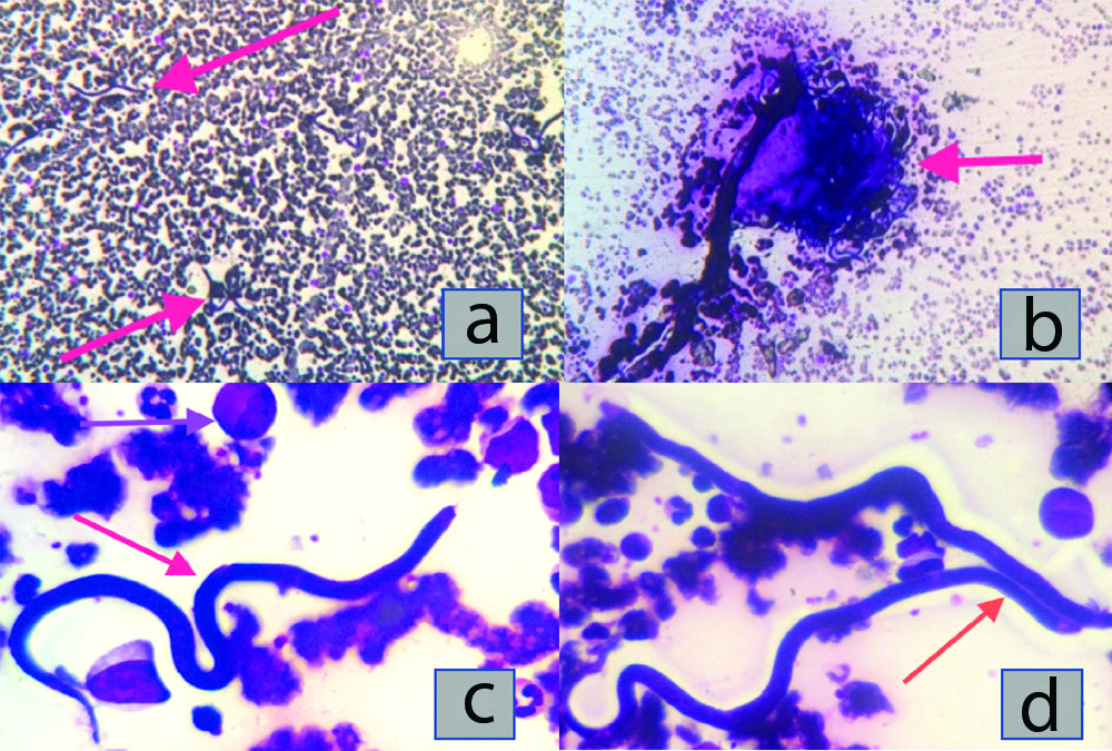 Wuchereria Bancrofti Slide