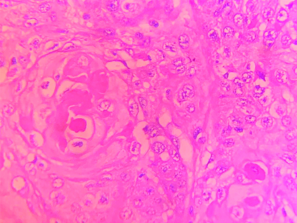 Squamous Cell Carcinoma Lung Keratin Pearls