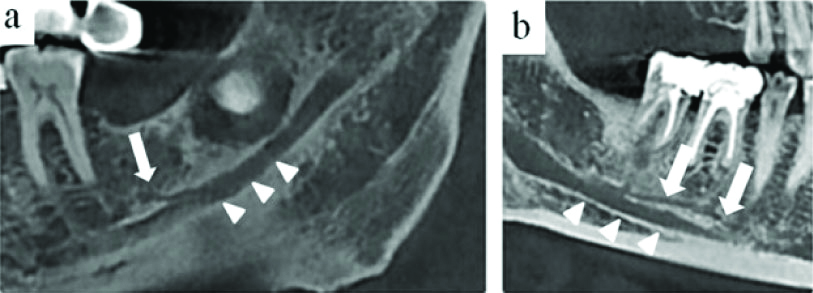 4. Buccolingual canal: Bifid mandibular canal that starts from the ...