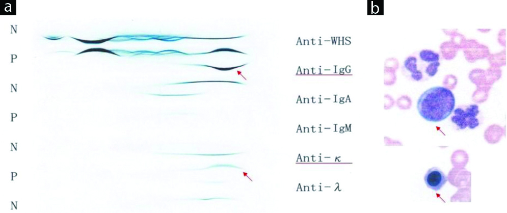 (a) Serum immuno-electrophoresis indicated a monoclonal elevation of ...