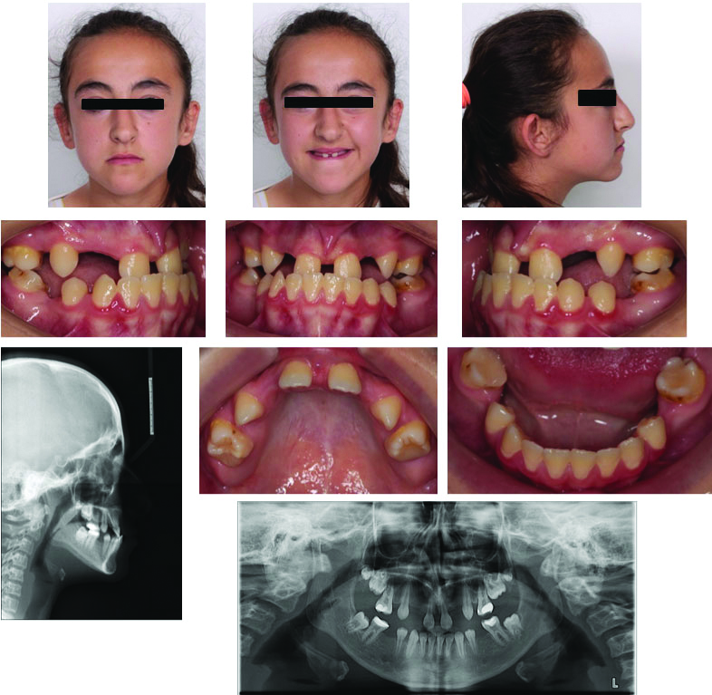 Post-protraction intraoral, extraoral photos lateral cephalogram and ...