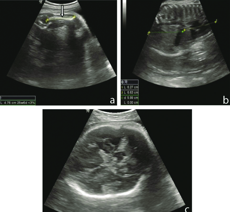 Macrocephaly Ultrasound