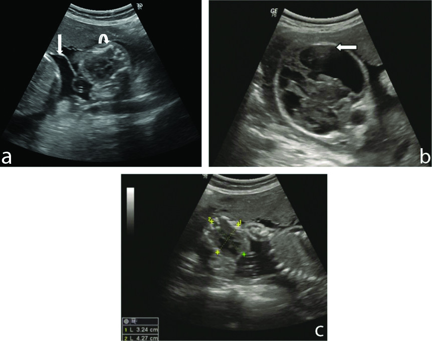 a) Ultrasound showing, Diamniotic twin fetusesshowing intertwin ...