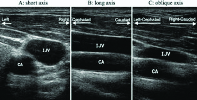 Different axis views for internal jugular vein cannulation under USG ...