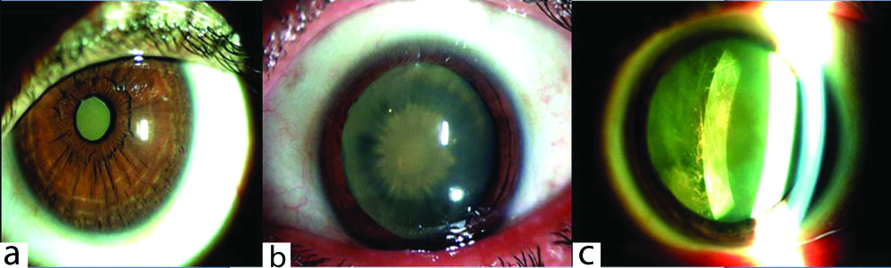 Slit lamp photograph of left eye of patient: (a) Appearance of cataract ...