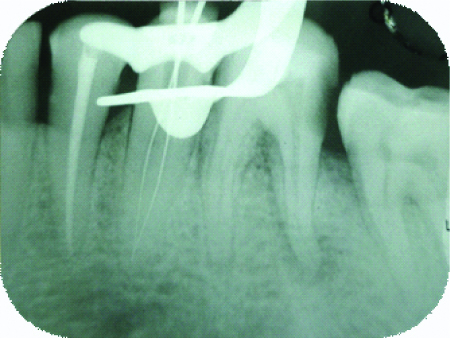 Working length IOPA.