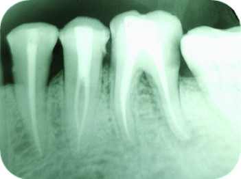 IOPA after 6 months.