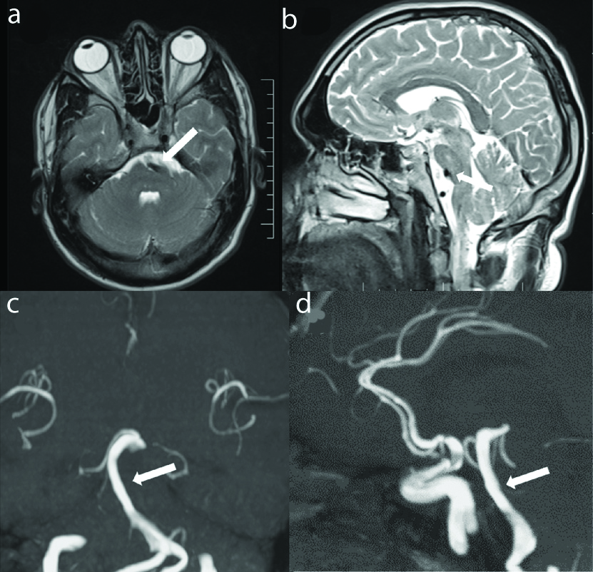 Basilar Artery Mri