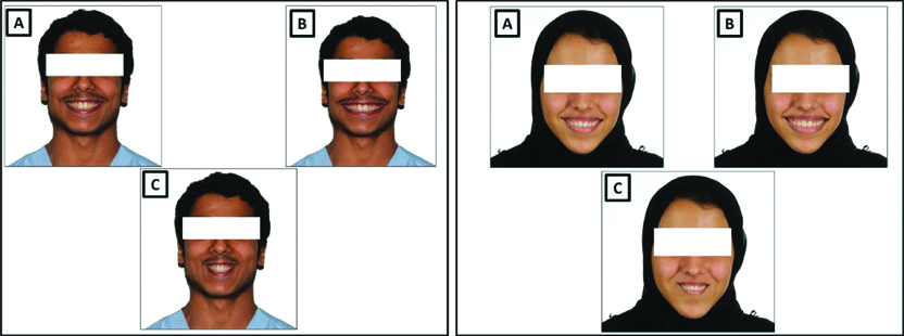 The smile index was obtained by dividing the inter-commissural width by ...