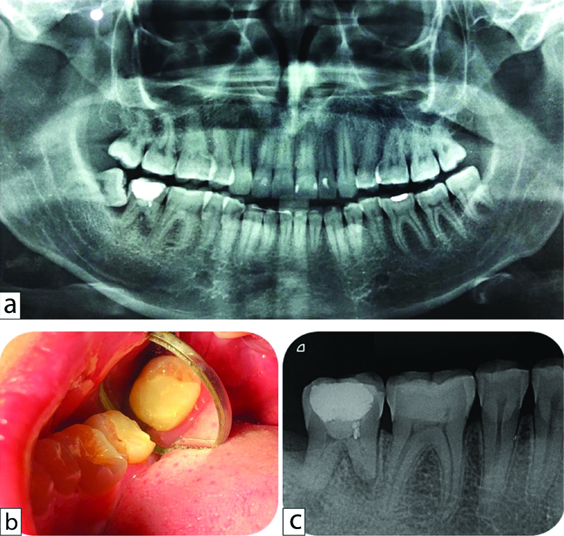 Tooth Periapical Lesion