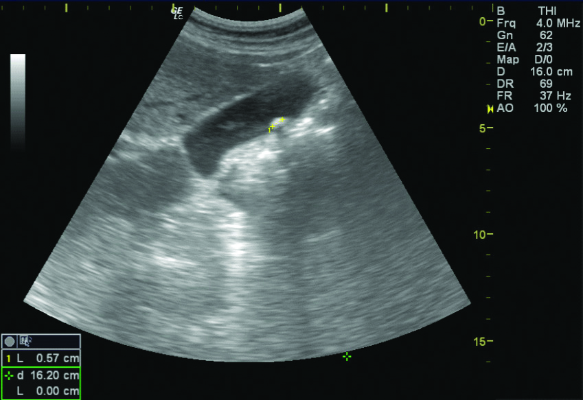 Calculi picked up as hyperdense foci on CT images.