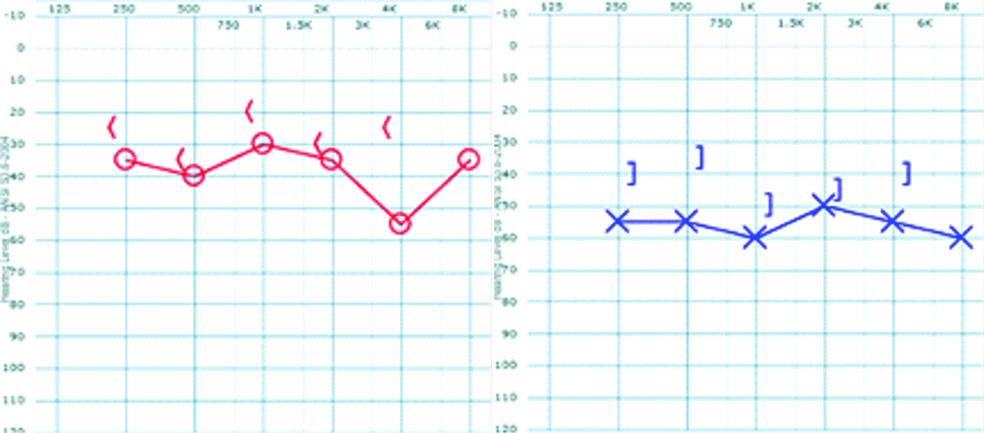 Normal Pure Tone Audiogram