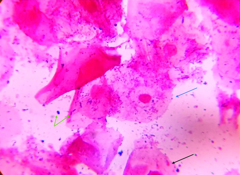 Gram-stained smear of vaginal discharge under 100X magnification of a ...