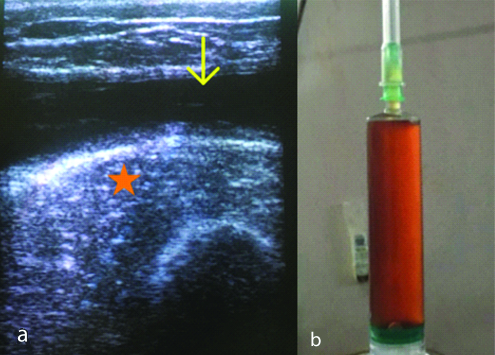 Serosanguinous Drainage