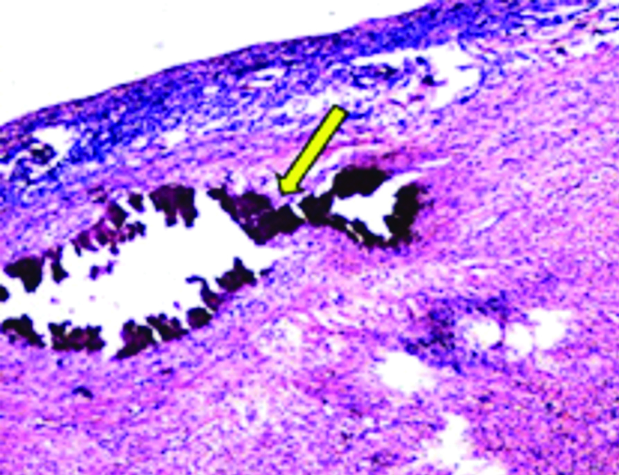 Microphotograph showed cardiac calcification in a female foetus of 29 ...