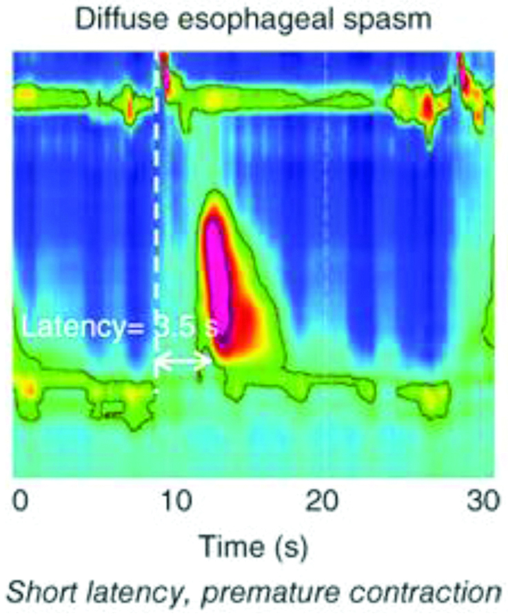 Diffuse Esophageal Spasm Manometry