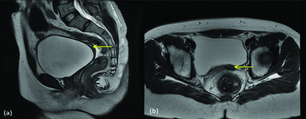 MDA class Id (a) T2 axial (b) STIR coronal and (c) T2 sagittal images ...