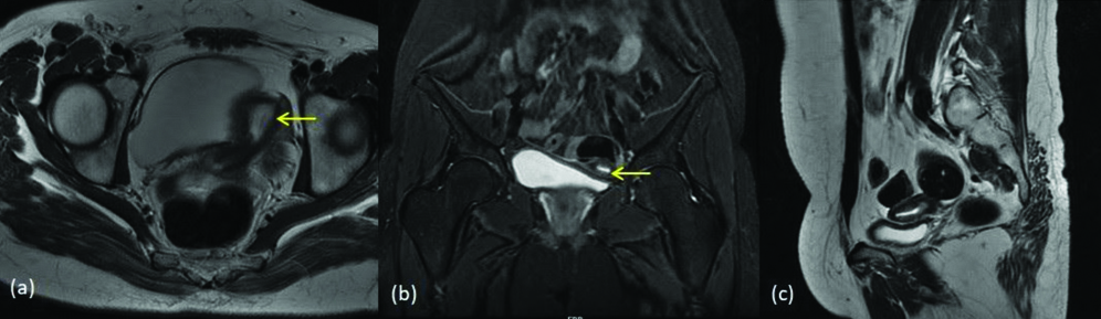 MDA class Id (a) T2 axial (b) STIR coronal and (c) T2 sagittal images ...