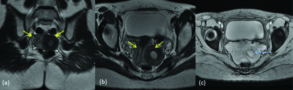 MDA class IId (a) T2 coronal image (b) T2 sagittal image shows curved ...