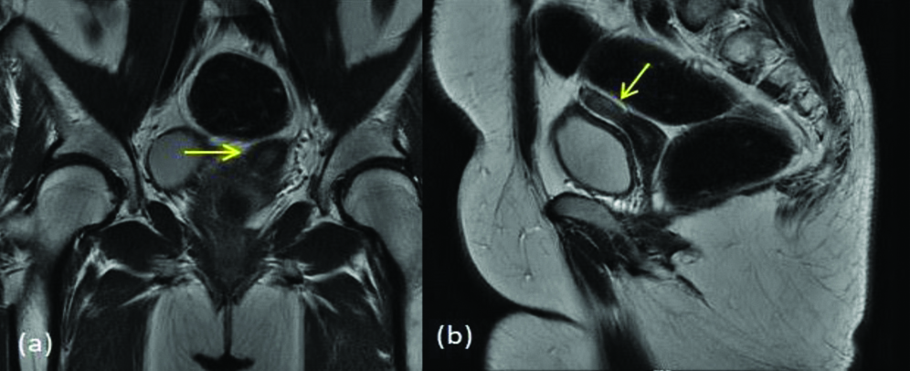 MDA class IId (a) T2 coronal image (b) T2 sagittal image shows curved ...