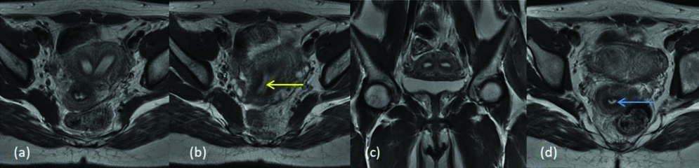 MDA class Va (a) T2 coronal (b) T2 axial (c) T2 axial- shows external ...