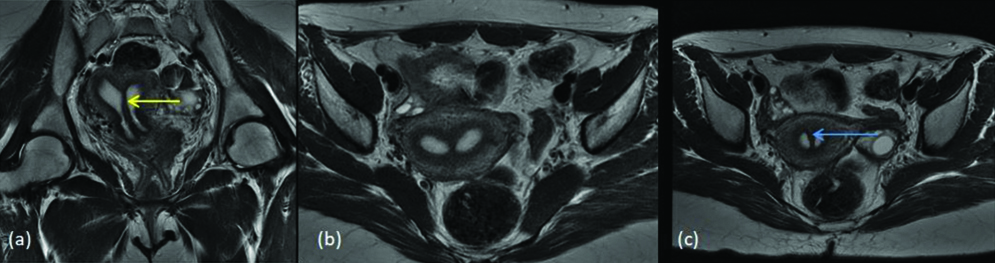 MDA class Va (a) T2 coronal (b) T2 axial (c) T2 axial- shows external ...