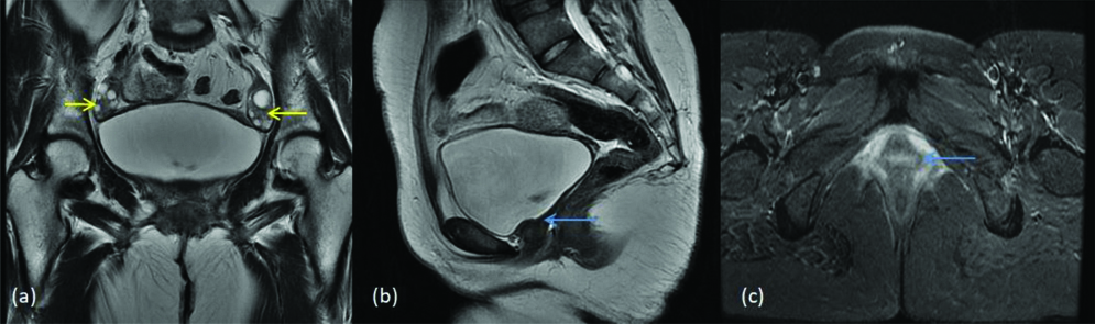 MRKH (a) T2 coronal shows normal bilateral ovaries (yellow arrows) with ...