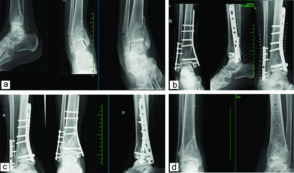 a) X-rays showing type A3 fracture with lateral malleoli fracture; b ...