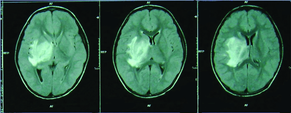 MRI image showing hyperintense lesion involving the right ...