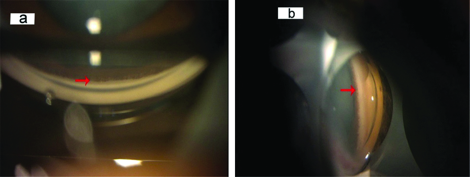 Posterior Embryotoxon Gonioscopy