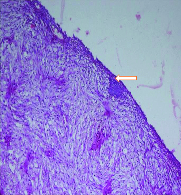 Section shows a cyst wall (marked by a white arrow) comprised of fibro ...