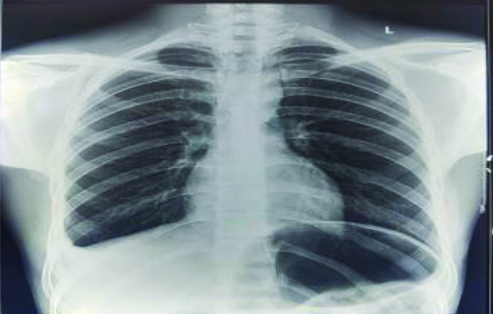 Minimal Pleural Effusion X Ray
