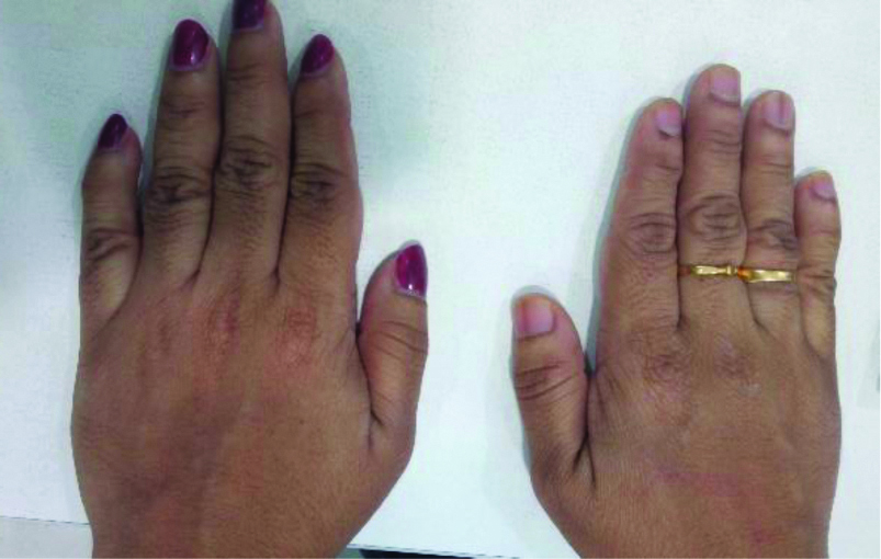 Clinical photograph of both hands of the patient demonstrating subtle ...