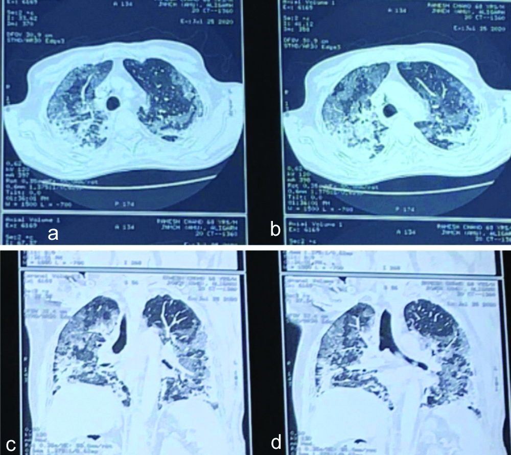 CT scan of patient 2 showing consolidatory patches with ground glass ...
