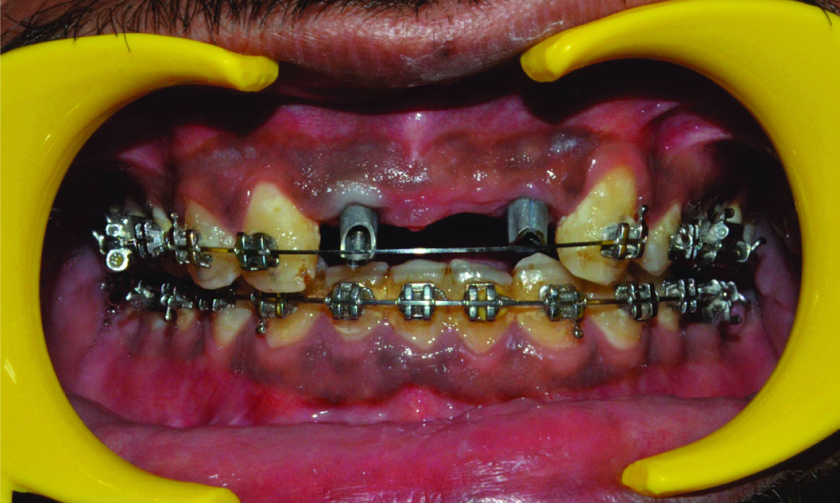 Mismatch of gingival zeniths of implant supported prosthesis vs natural ...