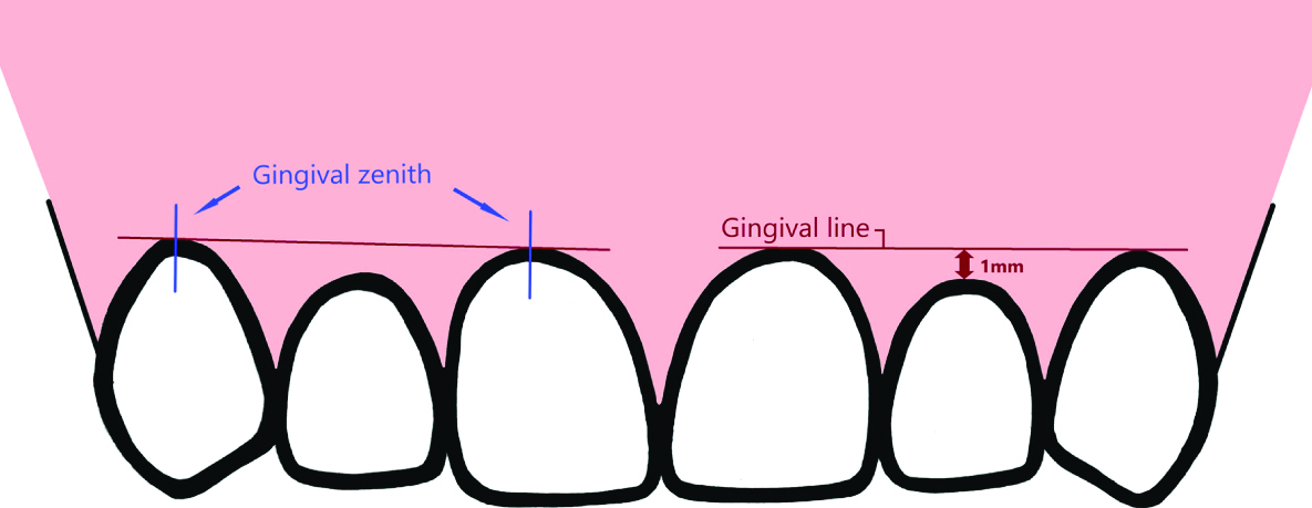 But in this case, the gingival zeniths of all the three units were ...