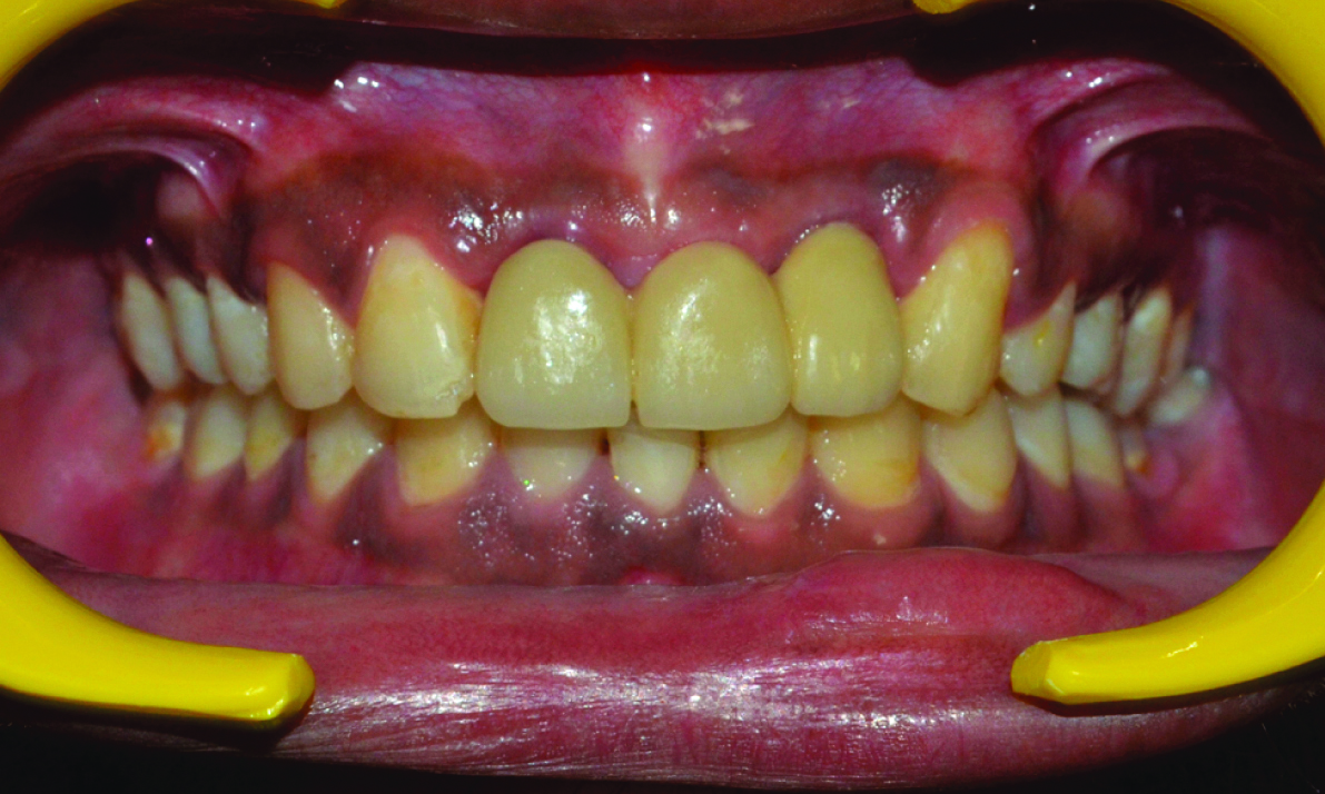 New prosthesis with improved aesthetics and gingival positions.