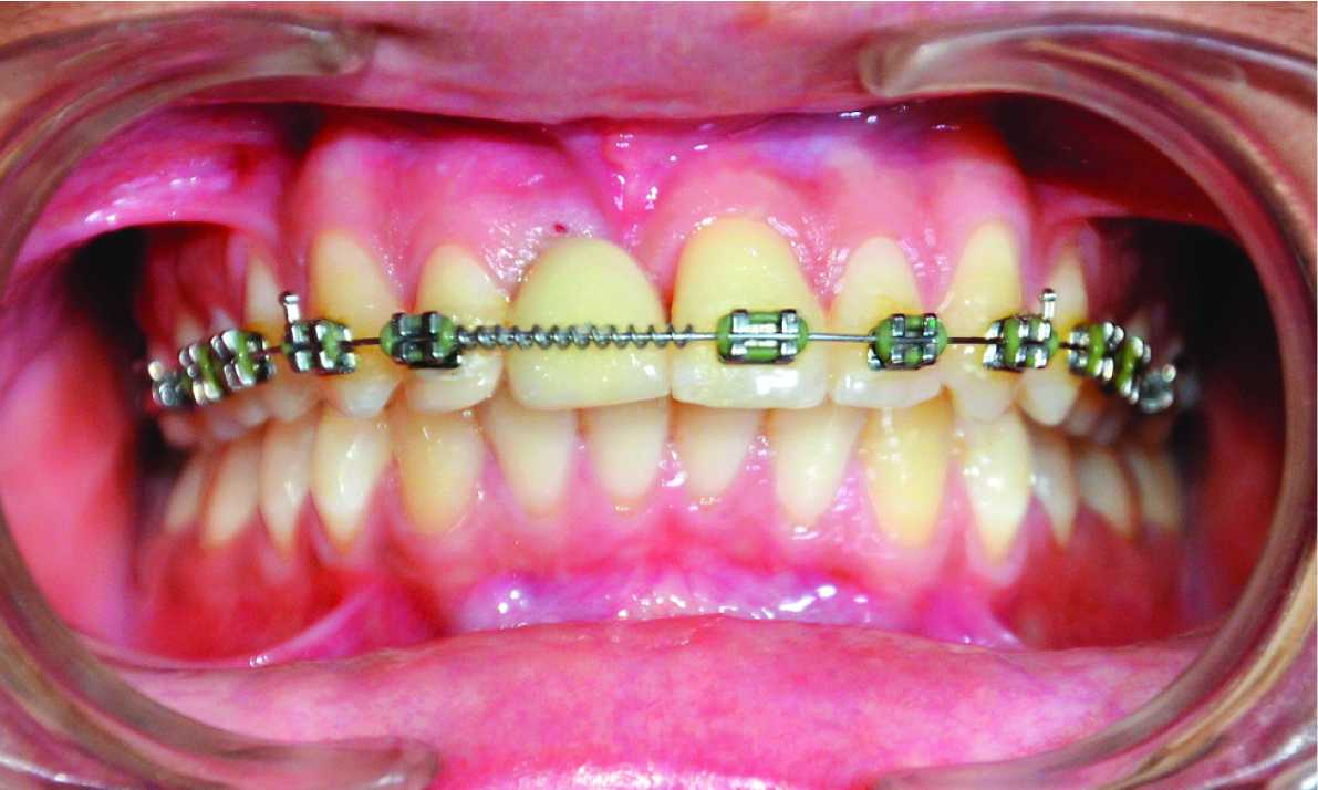Final prosthesis with improved aesthetics and dimensions.