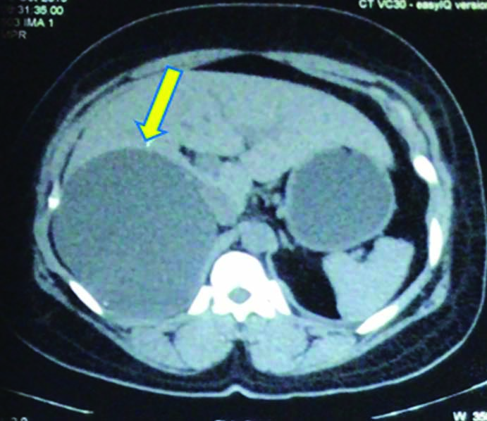 CECT image of reteroperitoneal cyst coronal section cyst marked with ...