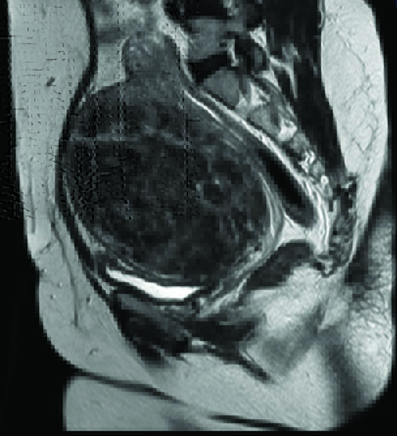 MRI pelvis revealing the sagittal section of the cervical fibroid.