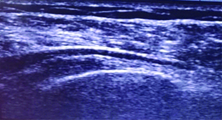 Rotator cuff pathology