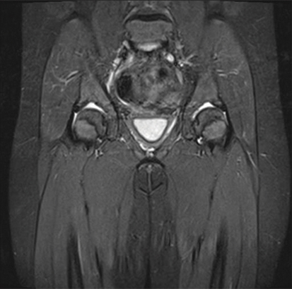 Acetabular Notch Mri