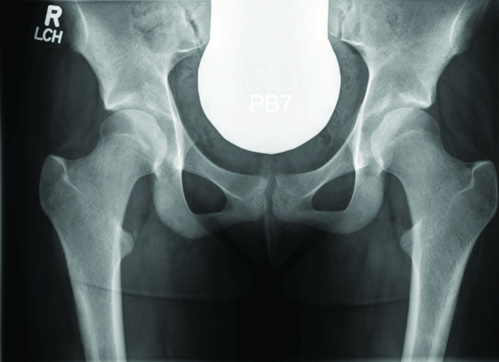 AP Plain-film radiograph of the pelvis demonstrating bilateral ...