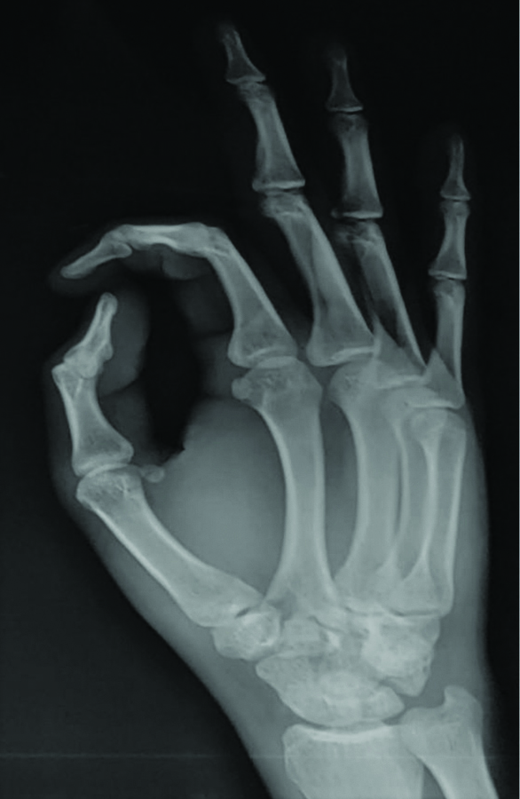 X-ray of the hand showing avulsion fracture of the base of the 2 nd ...