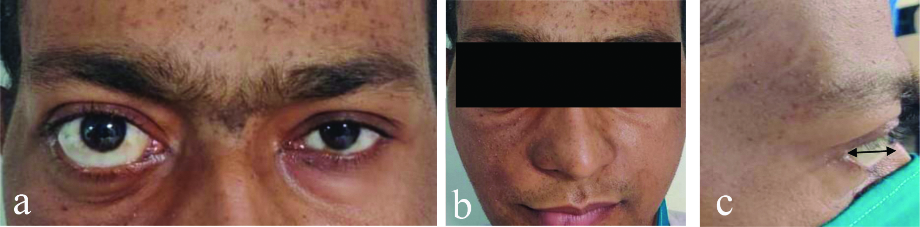 (a) Shows unilateral proptosis on the right side; b) Right side ...