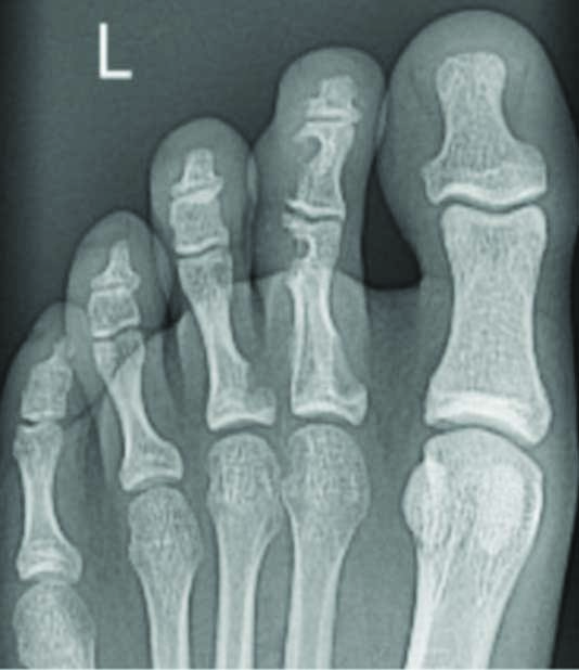 Multiple Enchondromatosis Histology