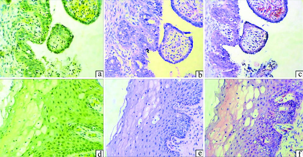 a-f: Microphotographs of cervix lesions: Microglandular hyperplasia in ...